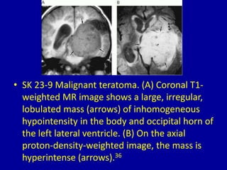 23 intraventricular masses | PPT