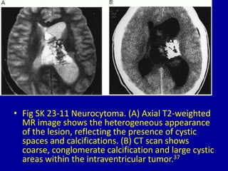 23 intraventricular masses | PPT
