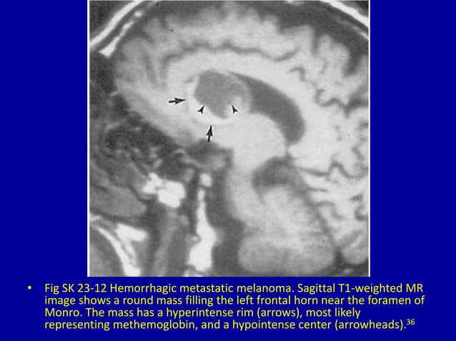 23 intraventricular masses | PPT
