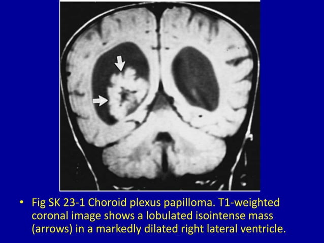 23 intraventricular masses | PPT