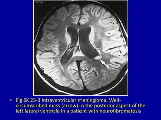 23 intraventricular masses | PPTX