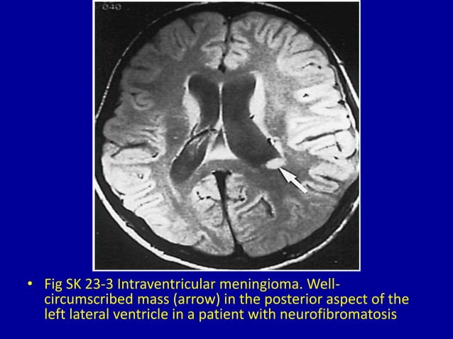 23 intraventricular masses | PPT