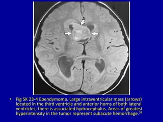 23 intraventricular masses | PPT