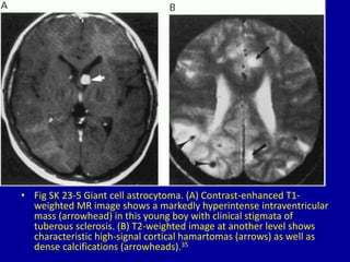 23 intraventricular masses | PPT