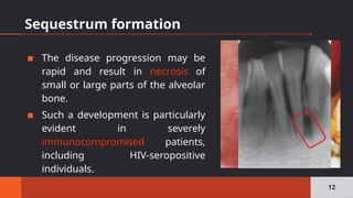 23 NUP.pptx Necrotizing Ulcerative Periodontitis Clinical features | PPTX