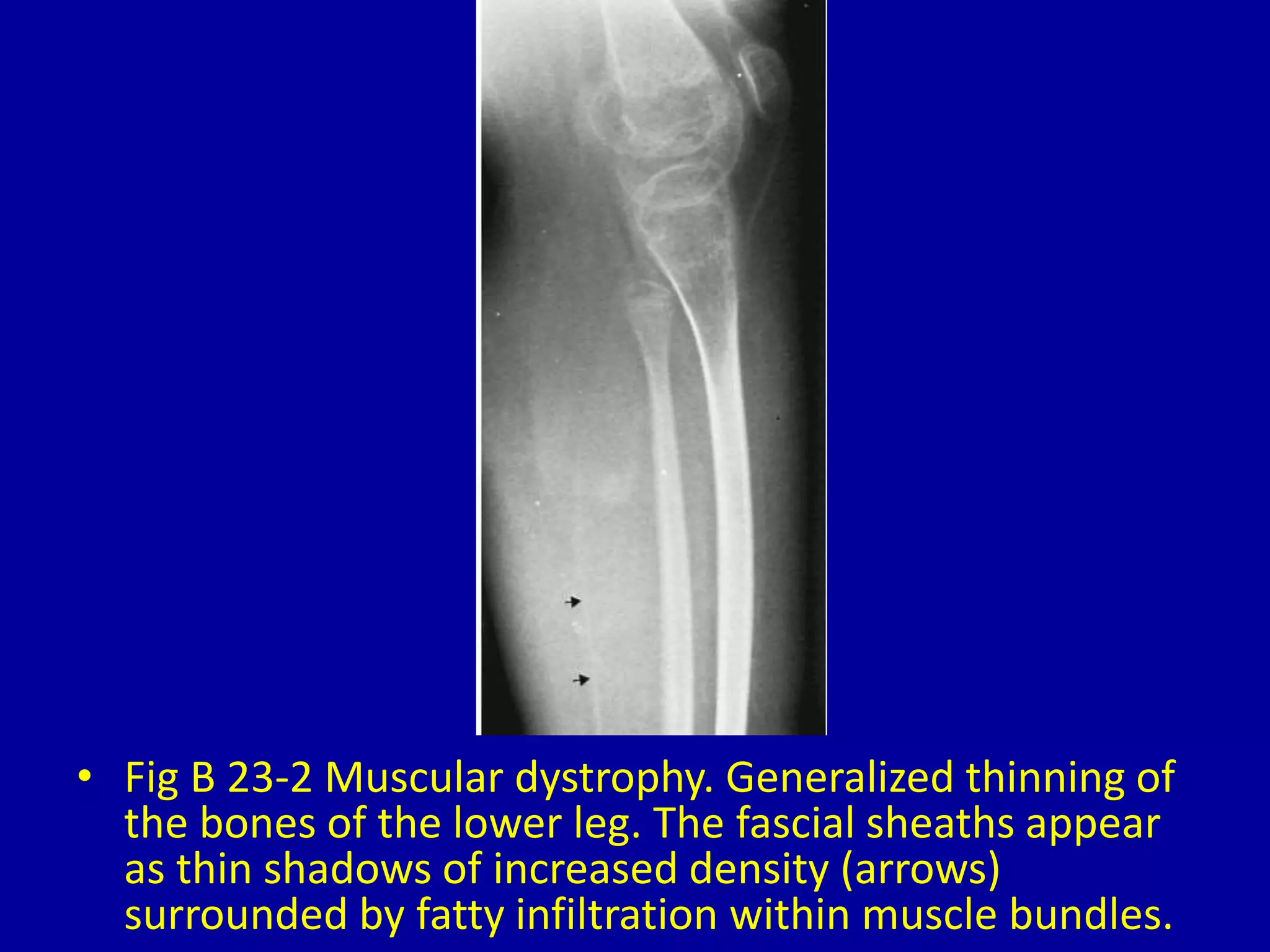 23 overconstriction or overtubulation (narrow diametaphysis) | PPTX