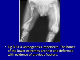 23 overconstriction or overtubulation (narrow diametaphysis) | PPTX