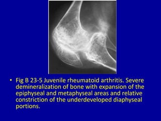 23 overconstriction or overtubulation (narrow diametaphysis) | PPTX