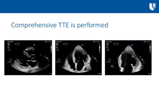 Case Study Comparison: Cardiac POCUS vs. Comprehensive TTE | PDF