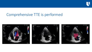 Case Study Comparison: Cardiac POCUS vs. Comprehensive TTE | PDF