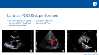 Case Study Comparison: Cardiac POCUS vs. Comprehensive TTE | PDF