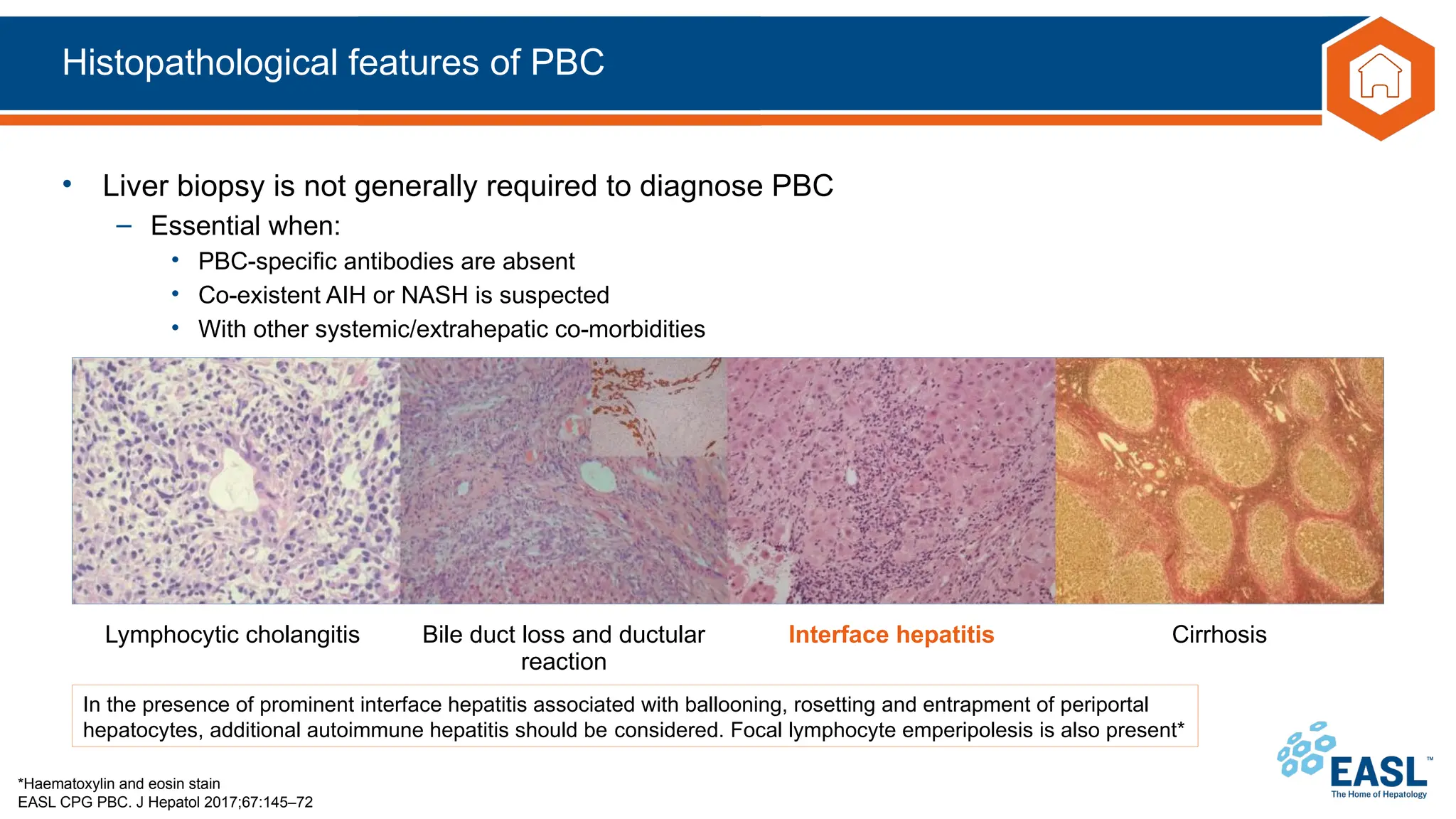23 Primary Biliary Cholangitis EASL Guideline 2017.pptx
