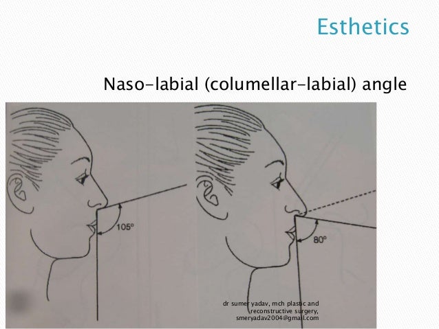 primary rhinoplasty