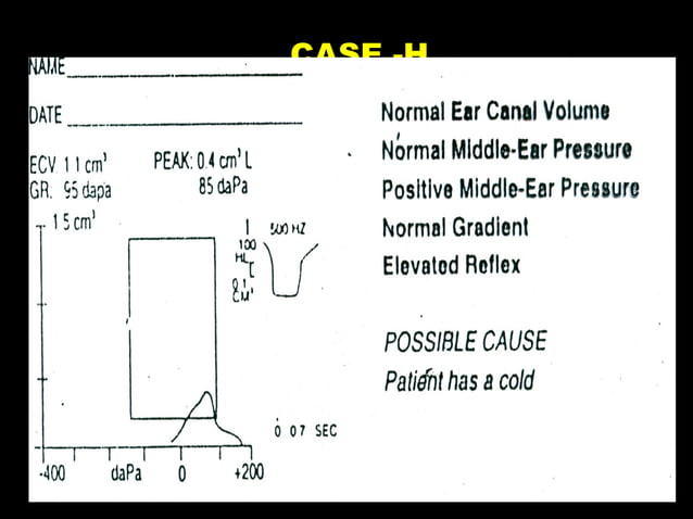 23rd B Lec 8 Riphah Immittance Audiometry.ppt