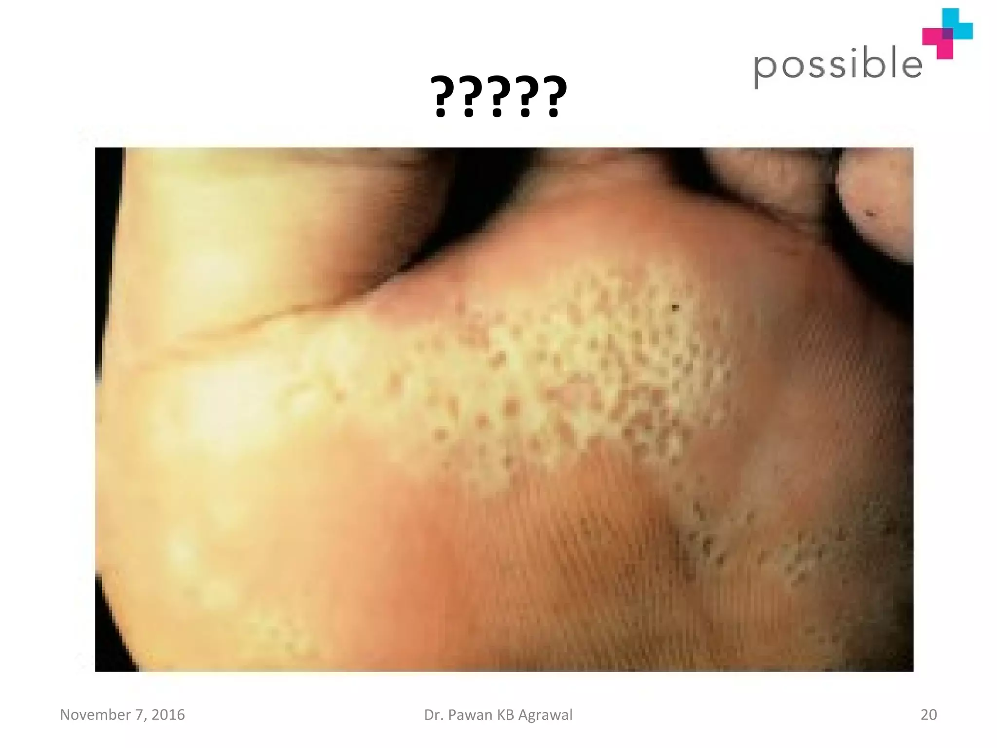 bacterial skin infections in general OPD | PPT