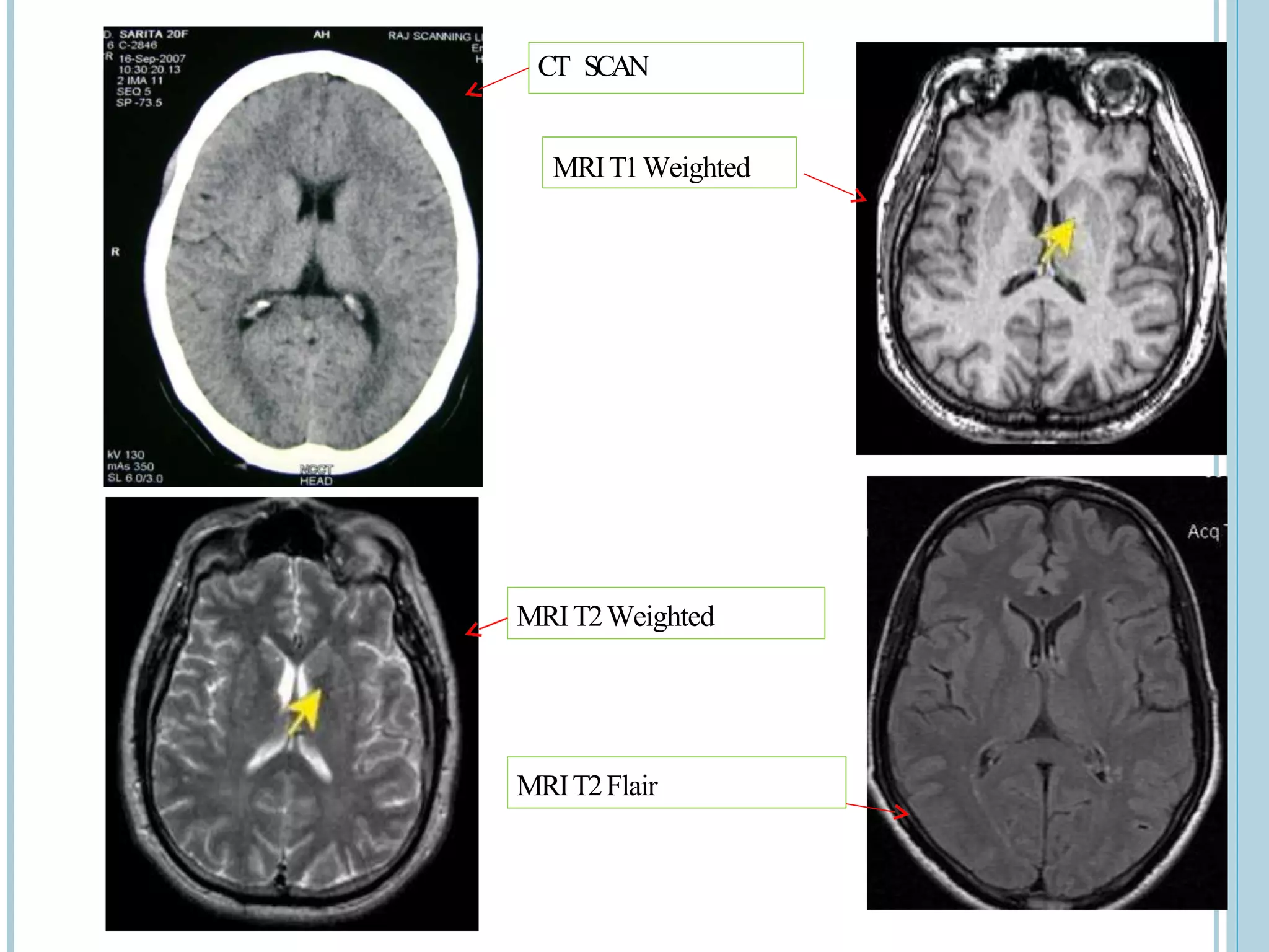 MRI basics - How to read and understand MRI sequences | PPTX