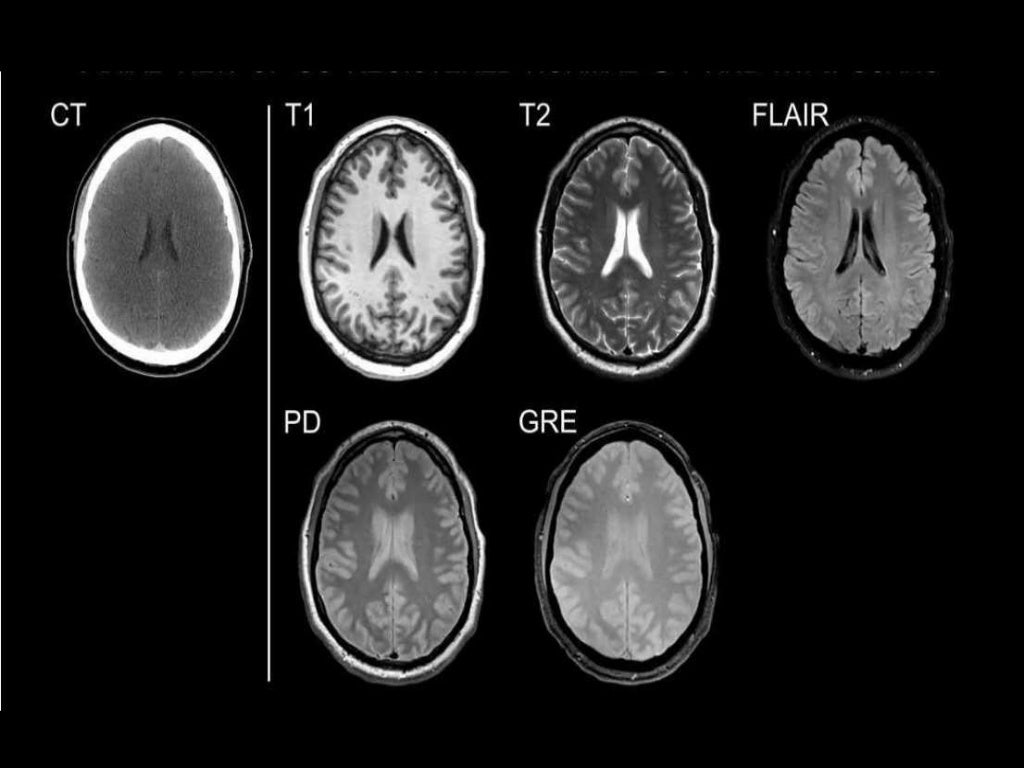 MRI basics - How to read and understand MRI sequences