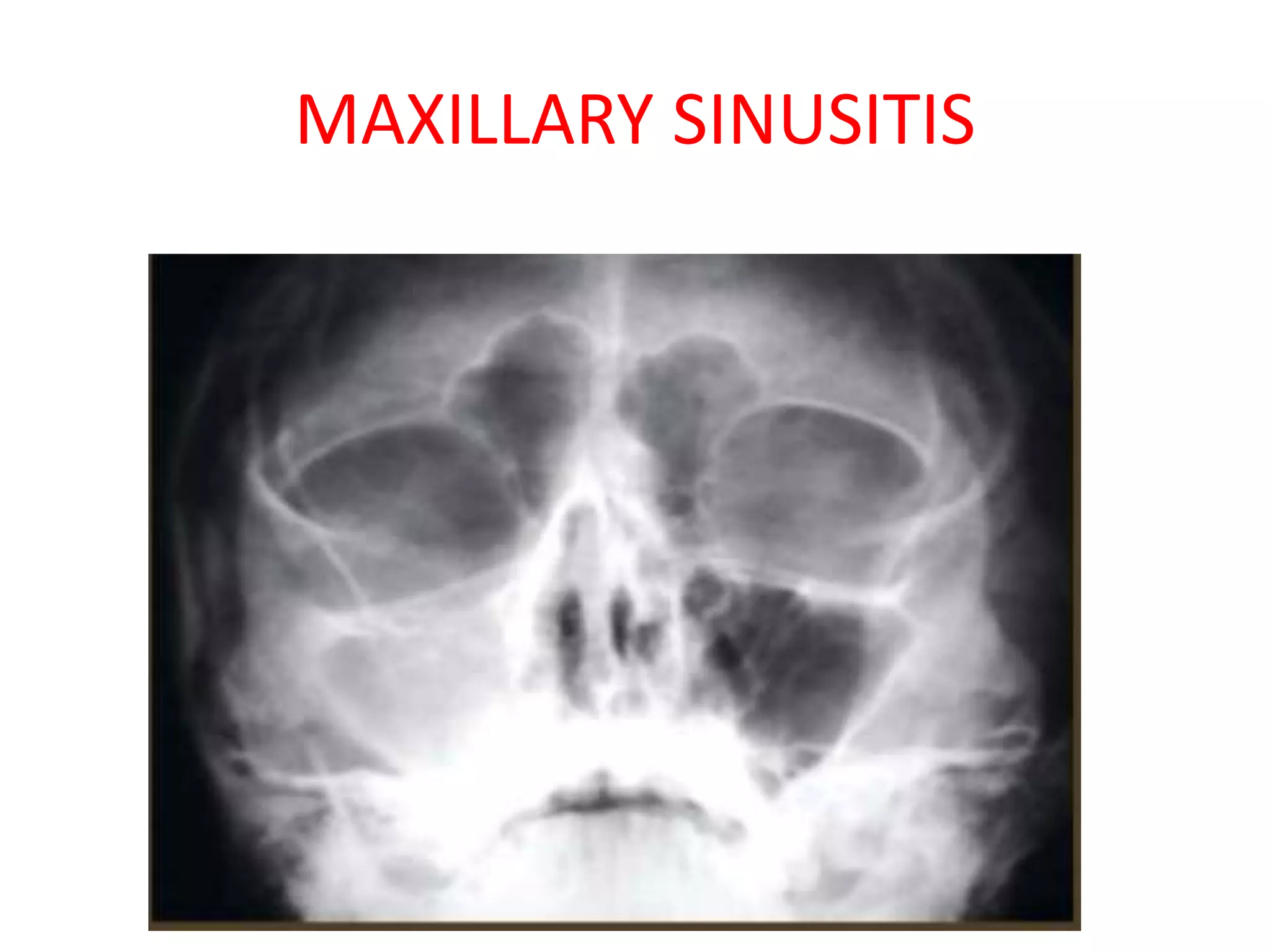 ACUTE & CHRONIC RHINOSINUSITIS | PPTX