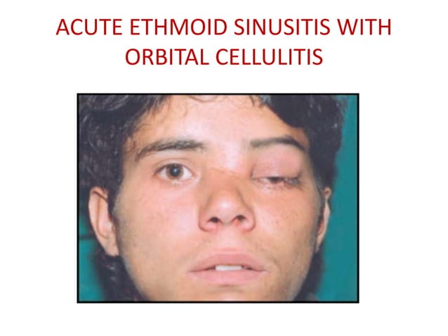 ACUTE & CHRONIC RHINOSINUSITIS | PPTX | Ear, Nose and Throat Conditions | Diseases and Conditions