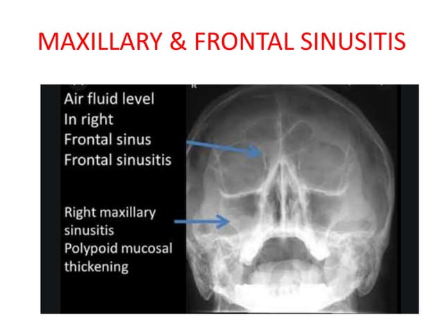 ACUTE & CHRONIC RHINOSINUSITIS | PPTX | Ear, Nose and Throat Conditions | Diseases and Conditions