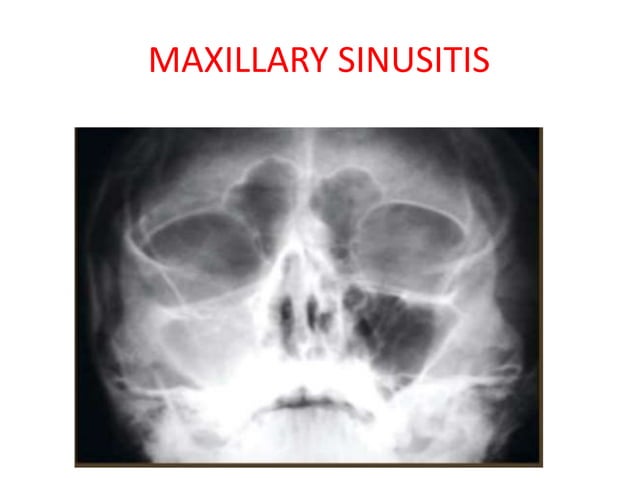 ACUTE & CHRONIC RHINOSINUSITIS | PPTX | Ear, Nose and Throat Conditions | Diseases and Conditions