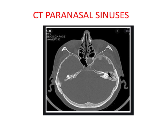 ACUTE & CHRONIC RHINOSINUSITIS | PPTX | Ear, Nose and Throat Conditions | Diseases and Conditions