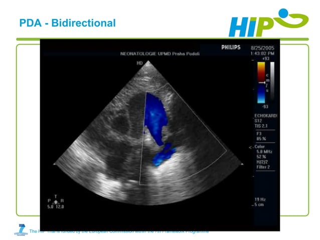 Functional Neonatal Echocardiography in Haemodynamic Disturbancies | PDF