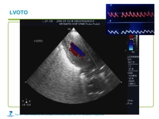 Functional Neonatal Echocardiography in Haemodynamic Disturbancies | PDF