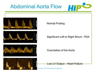 Functional Neonatal Echocardiography in Haemodynamic Disturbancies | PDF