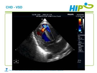 Functional Neonatal Echocardiography in Haemodynamic Disturbancies | PDF