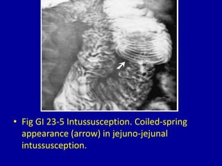 23 small bowel obstruction | PPTX
