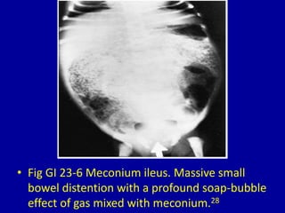23 small bowel obstruction | PPTX