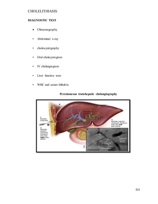 Cholelithiasis NCM 103 | PDF