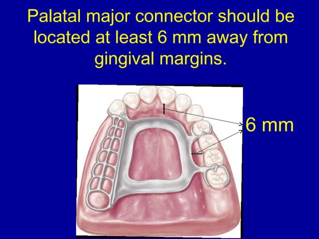 24. major connectors | PPT | Dental Health | Diseases and Conditions