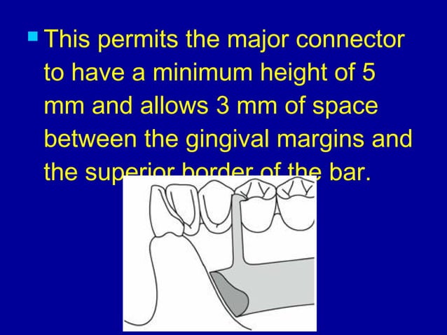 24. major connectors | PPT | Dental Health | Diseases and Conditions