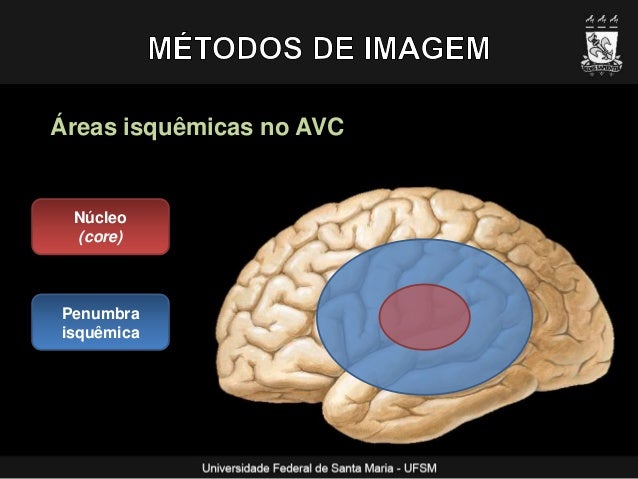 Neuroimagem no acidente vascular cerebral (AVC) - Liga Acadêmica de R…