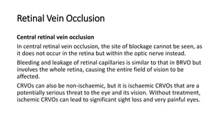 24. Retinal Vein Occlusion | PPTX