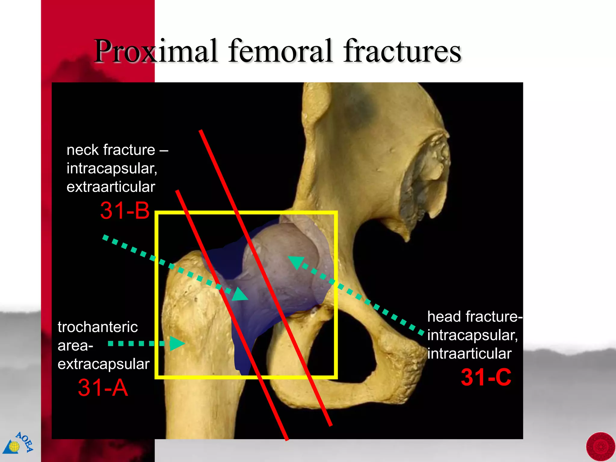 femoral neck and trochanteric fracture | PPT