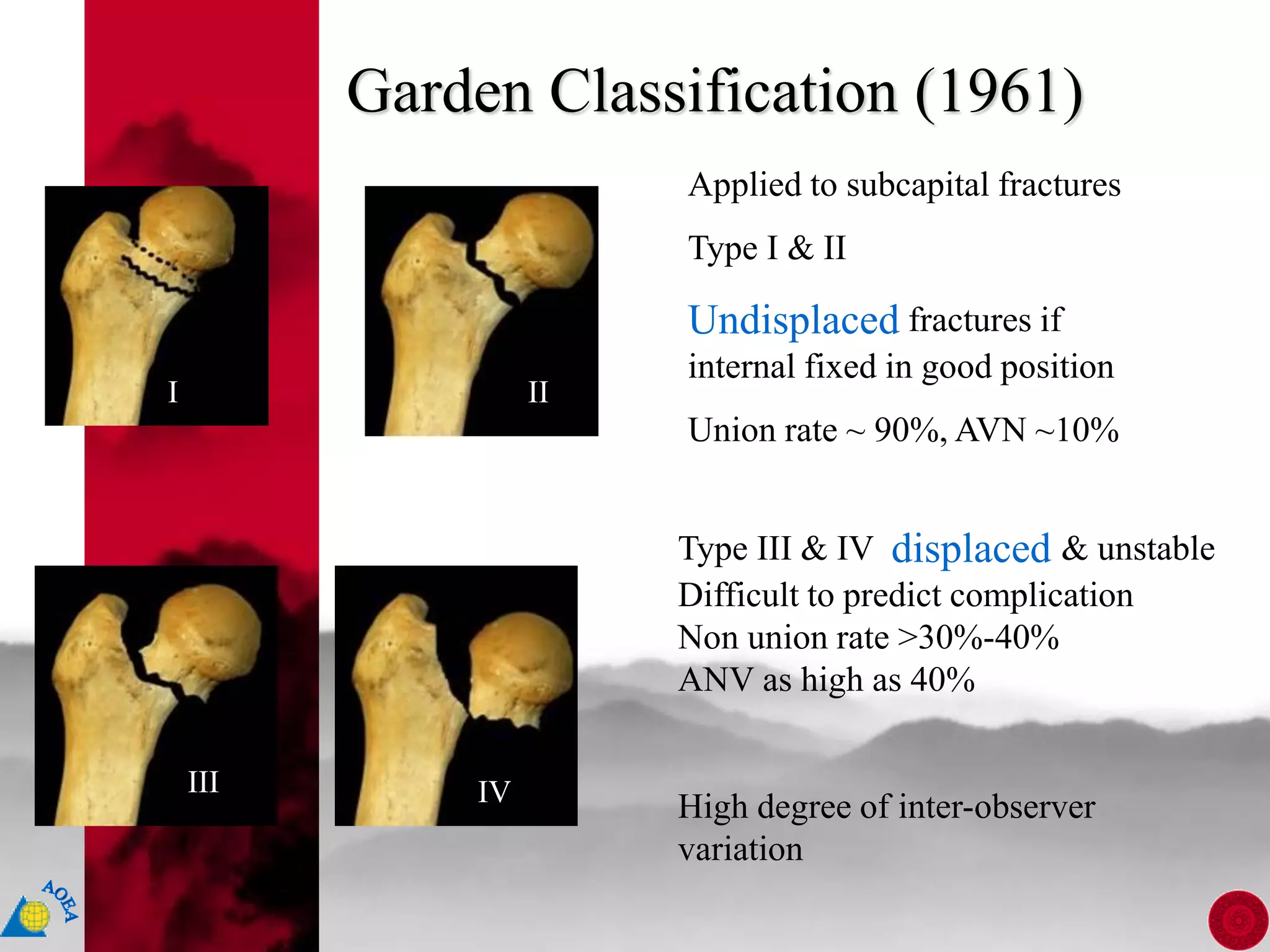 femoral neck and trochanteric fracture | PPT