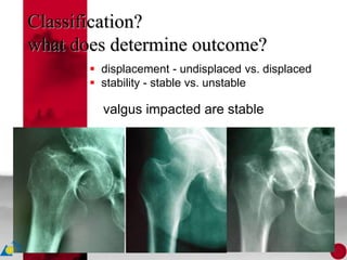 femoral neck and trochanteric fracture | PDF
