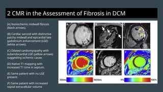 Emerging Techniques for Risk Stratification in Nonischemic Dilated ...