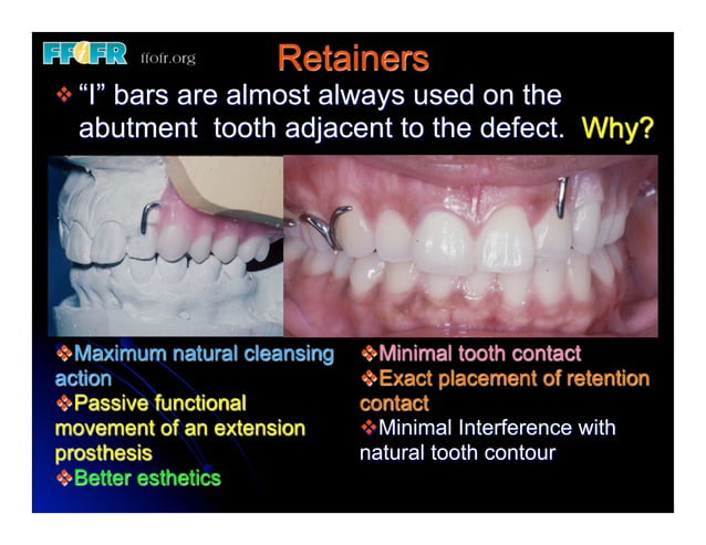 24.(new)mfp defects and rpd design | PDF | Dental Health | Diseases and ...
