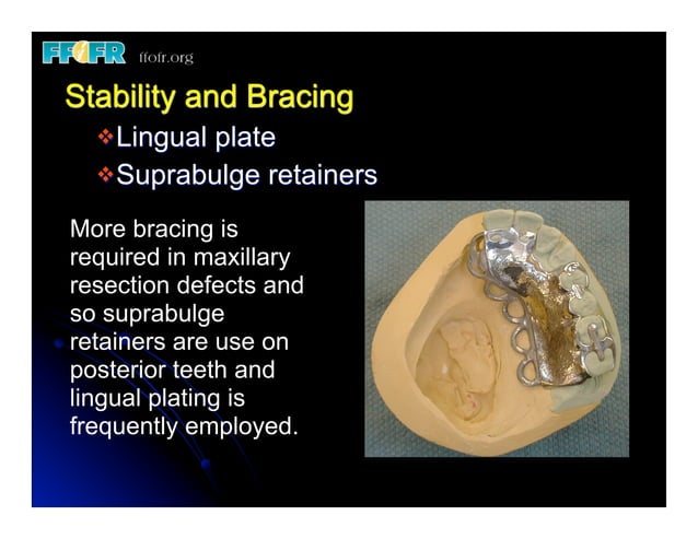 24.(new)mfp defects and rpd design | PDF | Dental Health | Diseases and ...