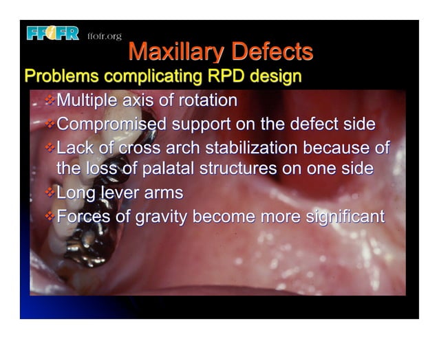 24.(new)mfp defects and rpd design | PDF | Dental Health | Diseases and ...