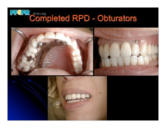 24.(new)mfp defects and rpd design | PDF | Dental Health | Diseases and ...