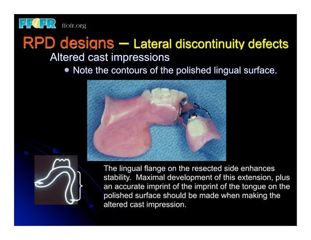 24.(new)mfp defects and rpd design | PDF | Dental Health | Diseases and ...