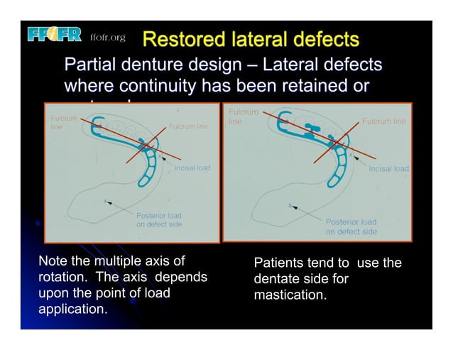 24.(new)mfp defects and rpd design | PDF | Dental Health | Diseases and ...