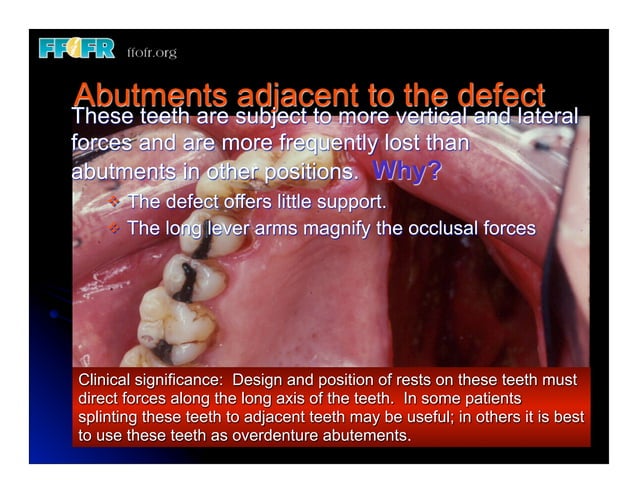 24.(new)mfp defects and rpd design | PDF | Dental Health | Diseases and ...