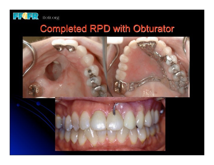 24.(new)mfp defects and rpd design