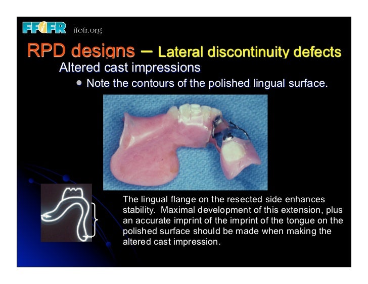 24.(new)mfp defects and rpd design
